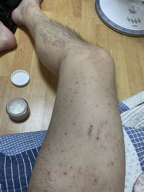 혐주의 화이자 백신 부작용 후기 포텐 터짐 최신순 에펨코리아