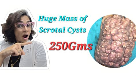 Treatment Of Huge Mass Of Scrotal Cystअंडकोष पर गांठ No 112 Youtube