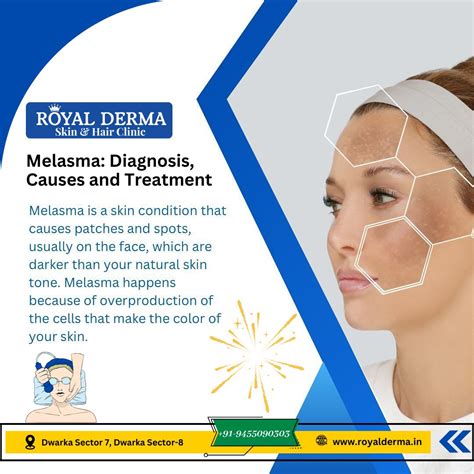 Melasma Diagnosis Causes And Treatment