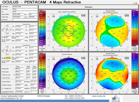 Figure 1 From Incidentally Discovered Keratoconus In Patients Seeking