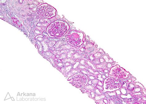 Diffuse And Nodular Glomerulosclerosis Low Pas Ismms Nephrology