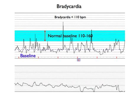 Basic Pattern Recognition Electronic Fetal Monitoring