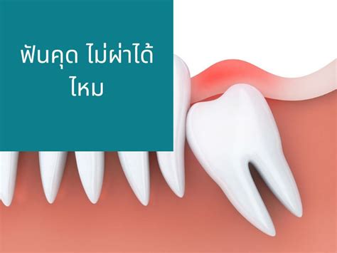 ฟันคุด ไม่ผ่าได้ไหม