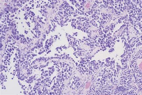 Soft Tissue Sarcoma Pathology Orthobullets