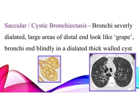 Bronchiectasis Ppt Pdf