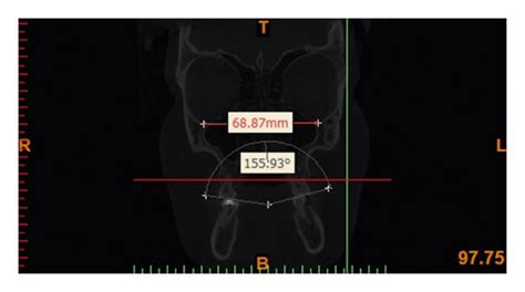 Measuring The Curve Of Wilson Download Scientific Diagram