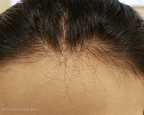 Before And After Mark Birch Hair