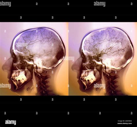 Stroke Treatment Coloured Angiogram Of The Brain Of A 48 Year Old