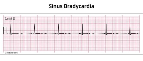 Acls Cardiac Arrest Algorithm Safety Training Seminars