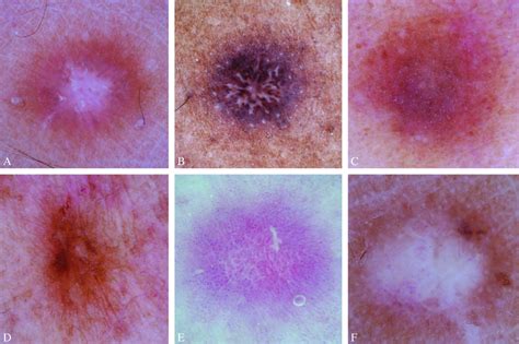 Dermoscopic Patterns Of Df A Network And Patch B Double Network