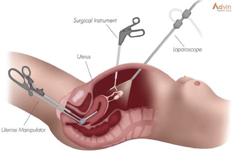 What Is A Hysterectomy Jaypeedigital Manual Of New Hysterectomy