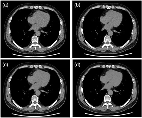 A 66‐year‐old Male A Axial Ct Image Reconstructed With Adaptive Download Scientific Diagram