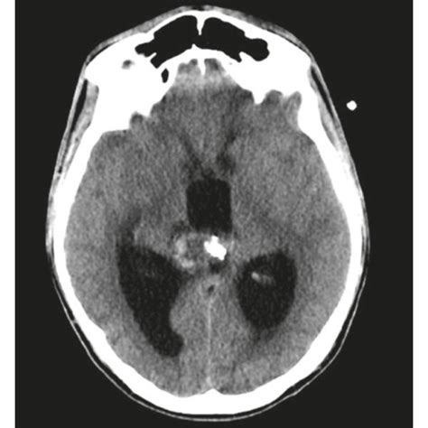 Ct Scan And Mri At Admission Documented Acute Obstructive Hydrocephalus
