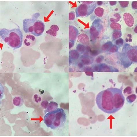 Plasma Cell Morphology In Bone Marrow Smears After Treatment