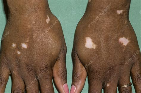 Vitiligo Skin Patches Stock Image C0465341 Science Photo Library