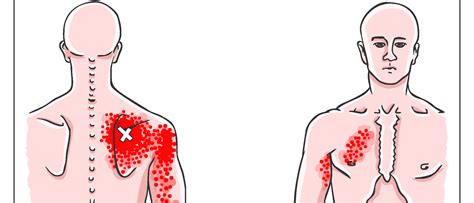 Supraspinatus Triggerpoint On Sale