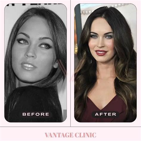 20 Celebrity Rhinoplasty Before And After Iconic Transformations