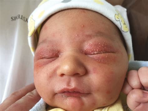 Newborn With Bilateral Eyelid Swelling Rash And Erythema Pmc