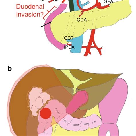 Preoperative Schema A The Mass Involves The Duodenum Transverse Download Scientific Diagram