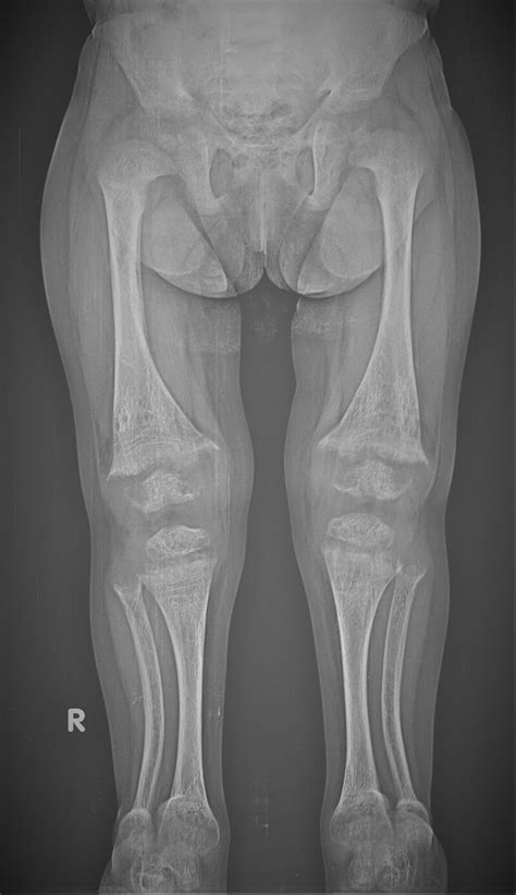 Radiopaedia Case Active Rickets Id 58738 Study 65957 Nc Commons