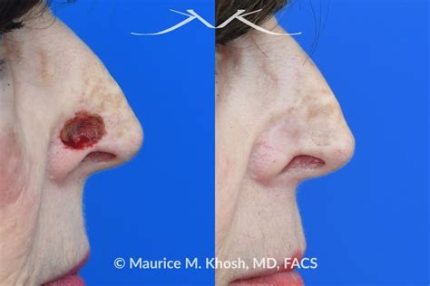 New York Facial Plastic Surgery Mohs Skin Cancer Reconstruction Before