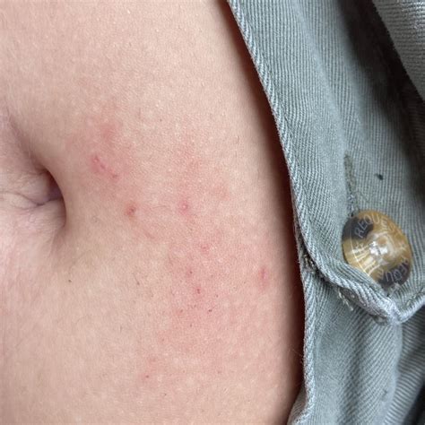 Anyone Got Any Tips For Ingrown Hairs That Keep Coming Back 😔 R