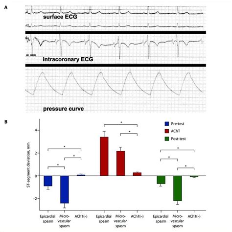 A An Example Of Intracoronary Electrocardiogram Ecg Recordings B
