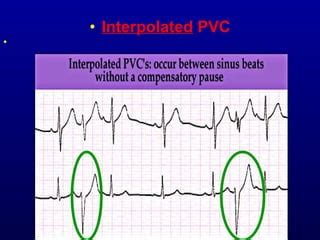 6th Part Ecg Basics Ventricular Arrhythmias Dr Salah Mabrouk Khallaf Ppt