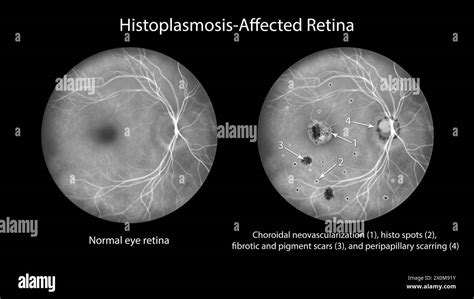 Histoplasmosis Eye Retina Louisville Histoplasmosis Ky Bennett
