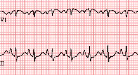 Biatrial Enlargement Ecg Made Simple