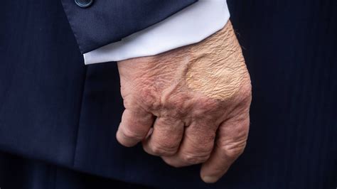 Trump Diagnosed With Chronic Venous Insufficiency After Undergoing Vascular Testing Because Of