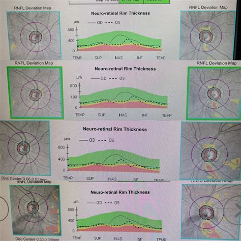 60yo F 3 Years A Glaucoma Suspect With Successive Octs Hvf Nl Gat Iop Od 16 18 18 Os 20 20