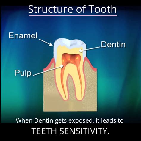 What Causes Extreme Teeth Sensitivity At James Frary Blog