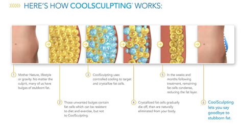 Coolsculpting Safe Non Invasive Fat Removal Treatment