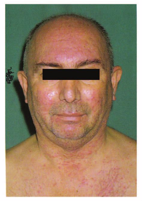 Erlotinib Rash Sparing Skin Of Rectangular Radiotherapy Field On The