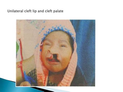 Congenital Malformations Ppt