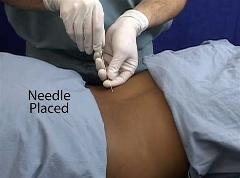 Epidural Injection Cervical Interlaminar Dark Skin Medivisuals Inc
