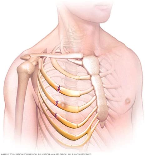 Fractura De Costilla Causas Síntomas Tratamiento Y Prevención