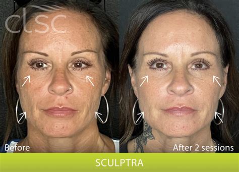 Sculptra Before And After Columbia Laser Skin Center