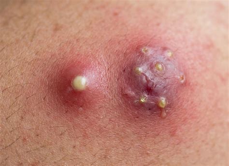 6 Warning Symptoms Of Boils And Carbuncles That Demand Attention