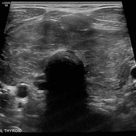 Transverse Grayscale Image Of The Thyroid Gland At The Level Of The