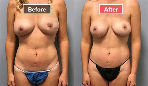 Gap Flap Procedure Mount Pleasant Sc East Cooper Plastic Surgery