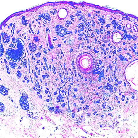 Pathology Outlines Trichoepithelioma Trichoblastoma