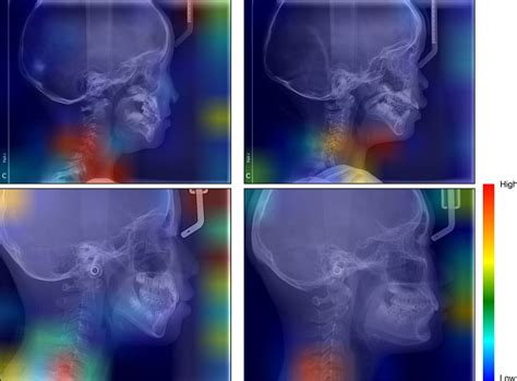 Age And Sex Estimation In Cephalometric Radiographs Based On Multitask Convolutional Neural