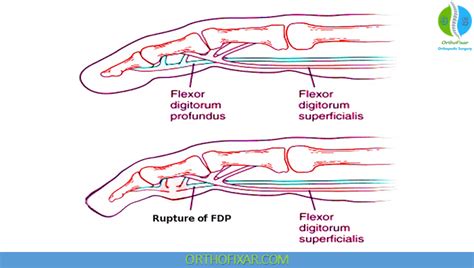 Flexor Digitorum Profundus Muscle Anatomy Orthofixar 2026