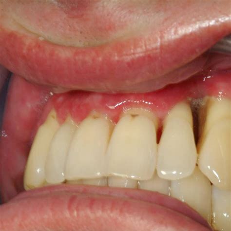 Necrotizing Ulcerative Periodontitis Involving Maxillary Left Lateral