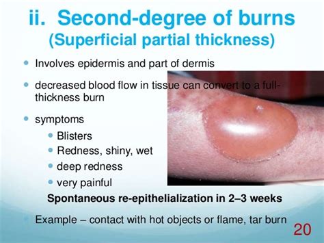 Burn Management