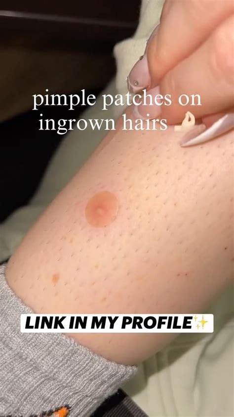 Acne Pimple Patch Artofit Acne Pimple Patch Artofit