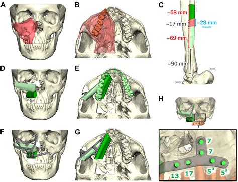 Advances In Midface Reconstruction Facial Plastic Surgery Clinics