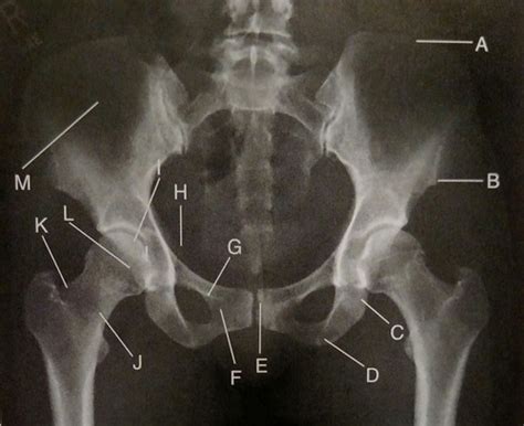 Pelvic Girdle Labeling [blank] Flashcards Quizlet